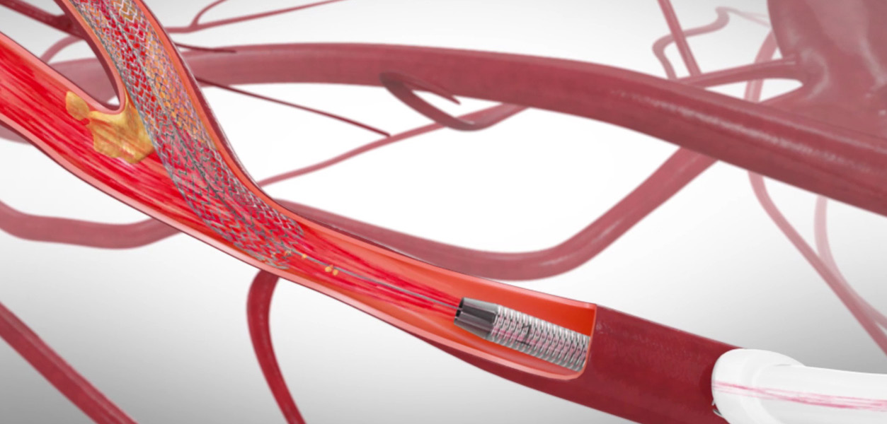 New Procedure Opens Doors - and Arteries - Covenant Health